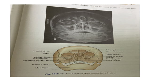 x ray cranium [Autosaved].pptx cranium xray | PPT