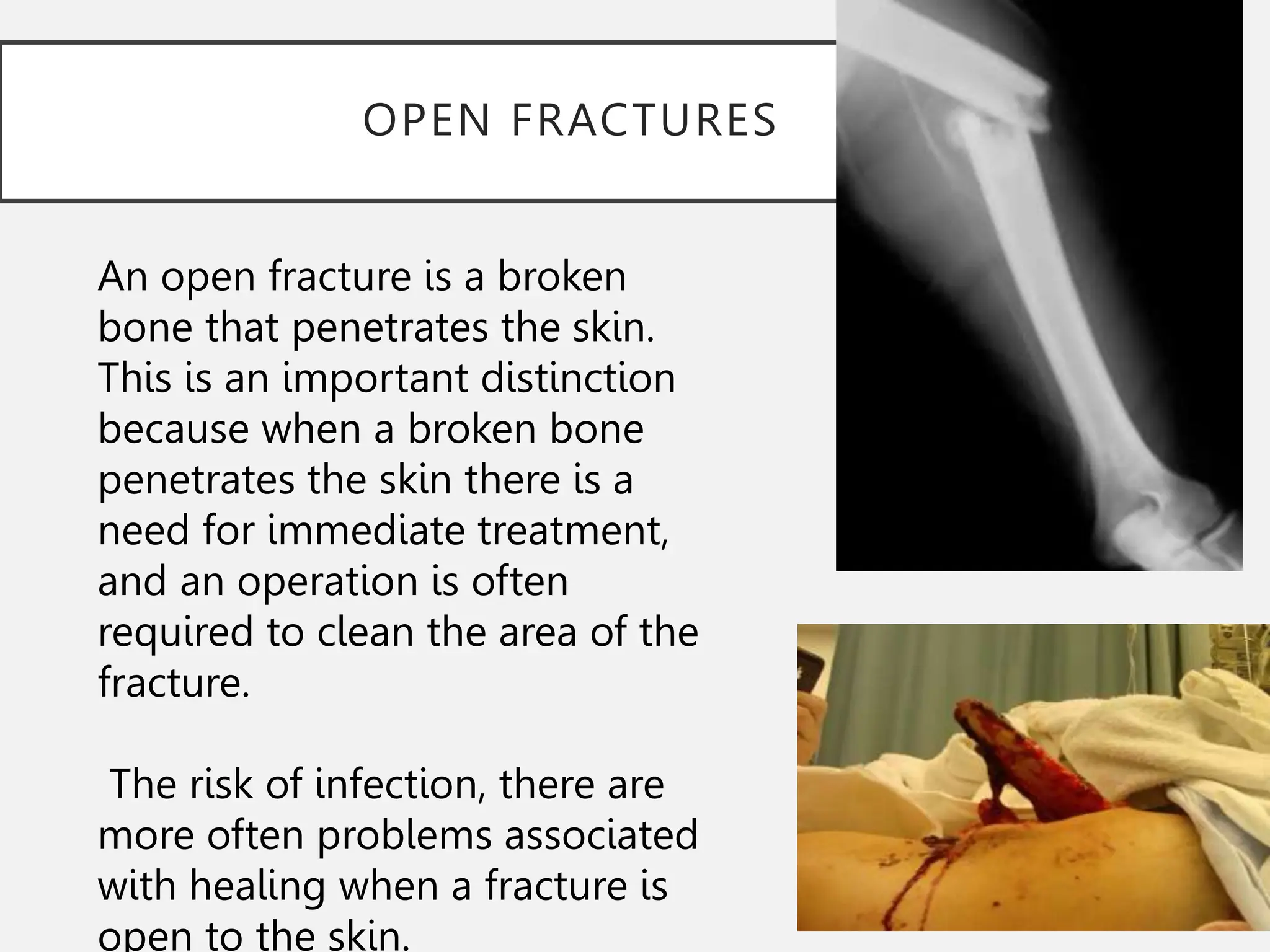 x ray diagnostics of fractures and dislocations.pptx
