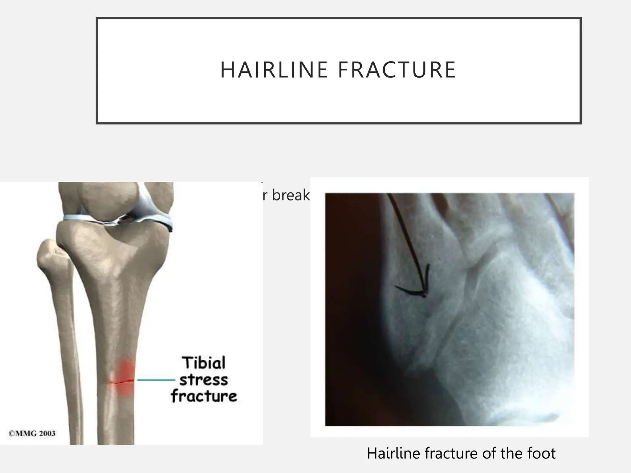 x ray diagnostics of fractures and dislocations.pptx
