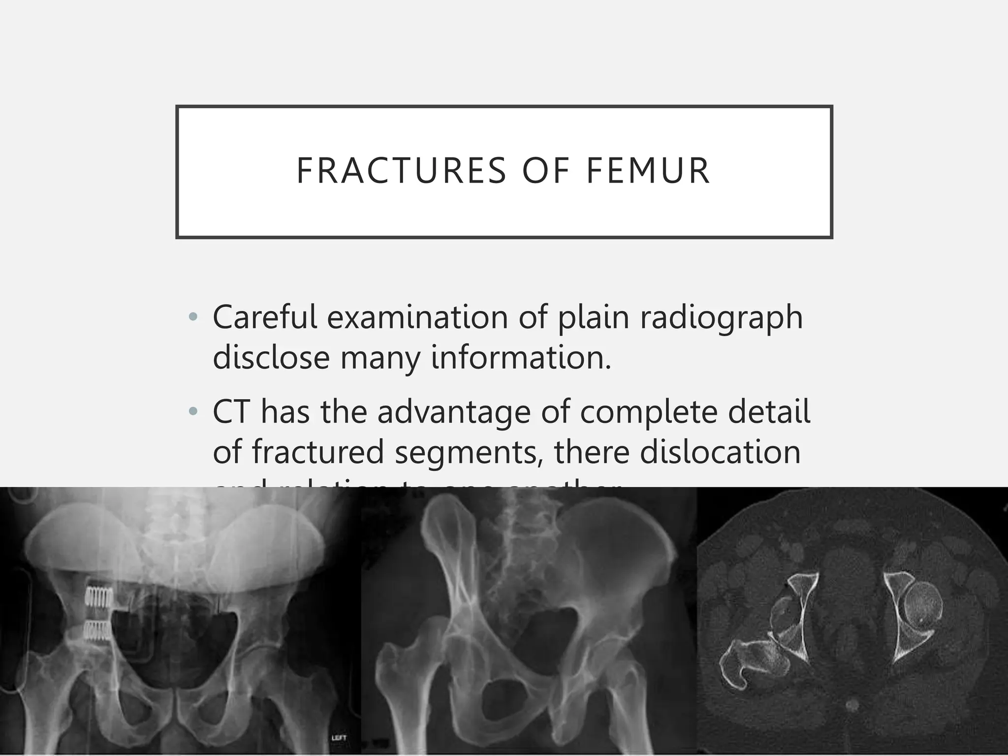 x ray diagnostics of fractures and dislocations.pptx