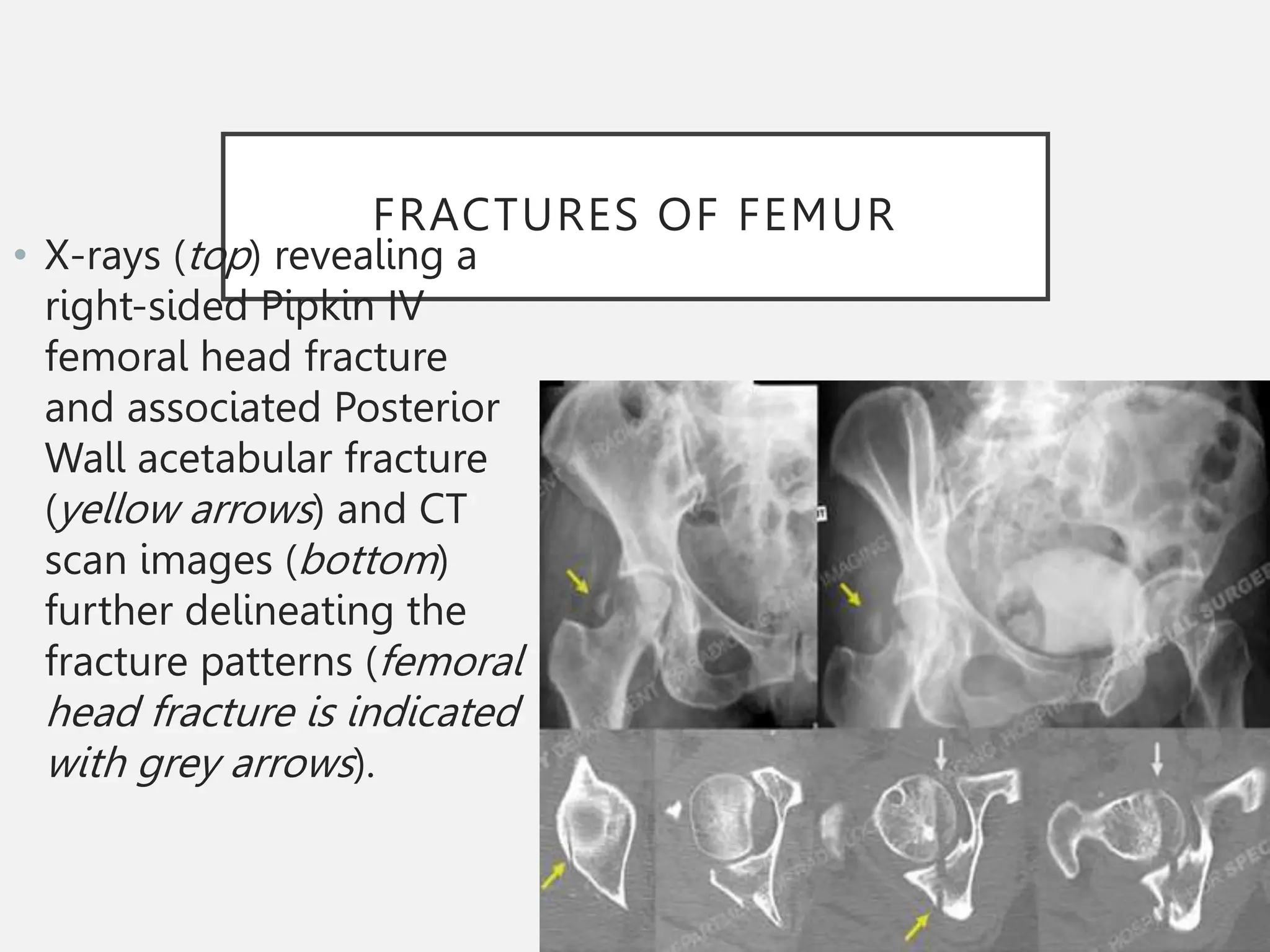 x ray diagnostics of fractures and dislocations.pptx