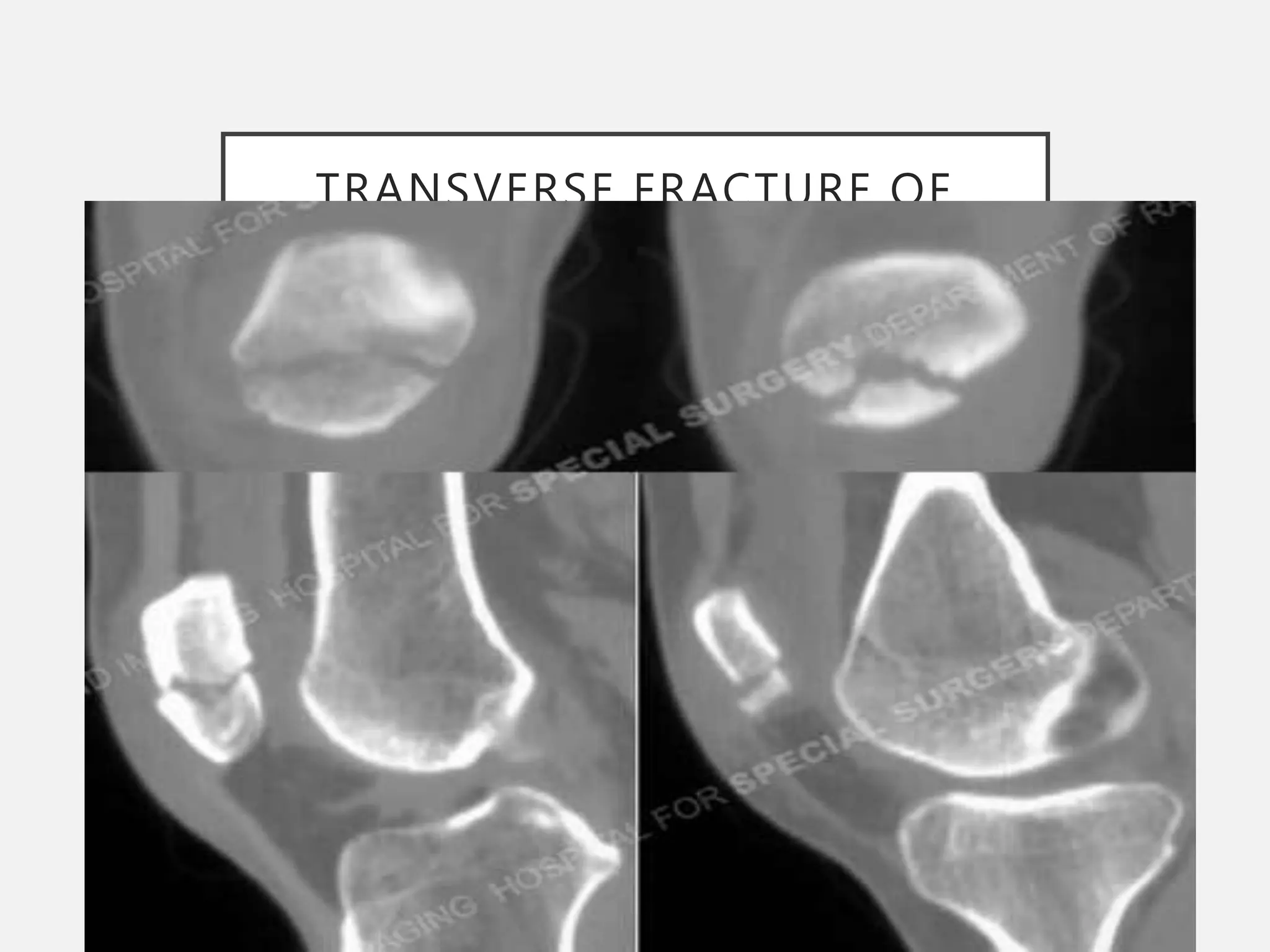 x ray diagnostics of fractures and dislocations.pptx