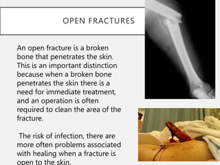 x ray diagnostics of fractures and dislocations.pptx