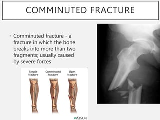 x ray diagnostics of fractures and dislocations.pptx