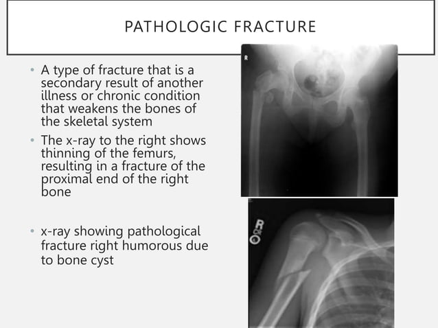 x ray diagnostics of fractures and dislocations.pptx