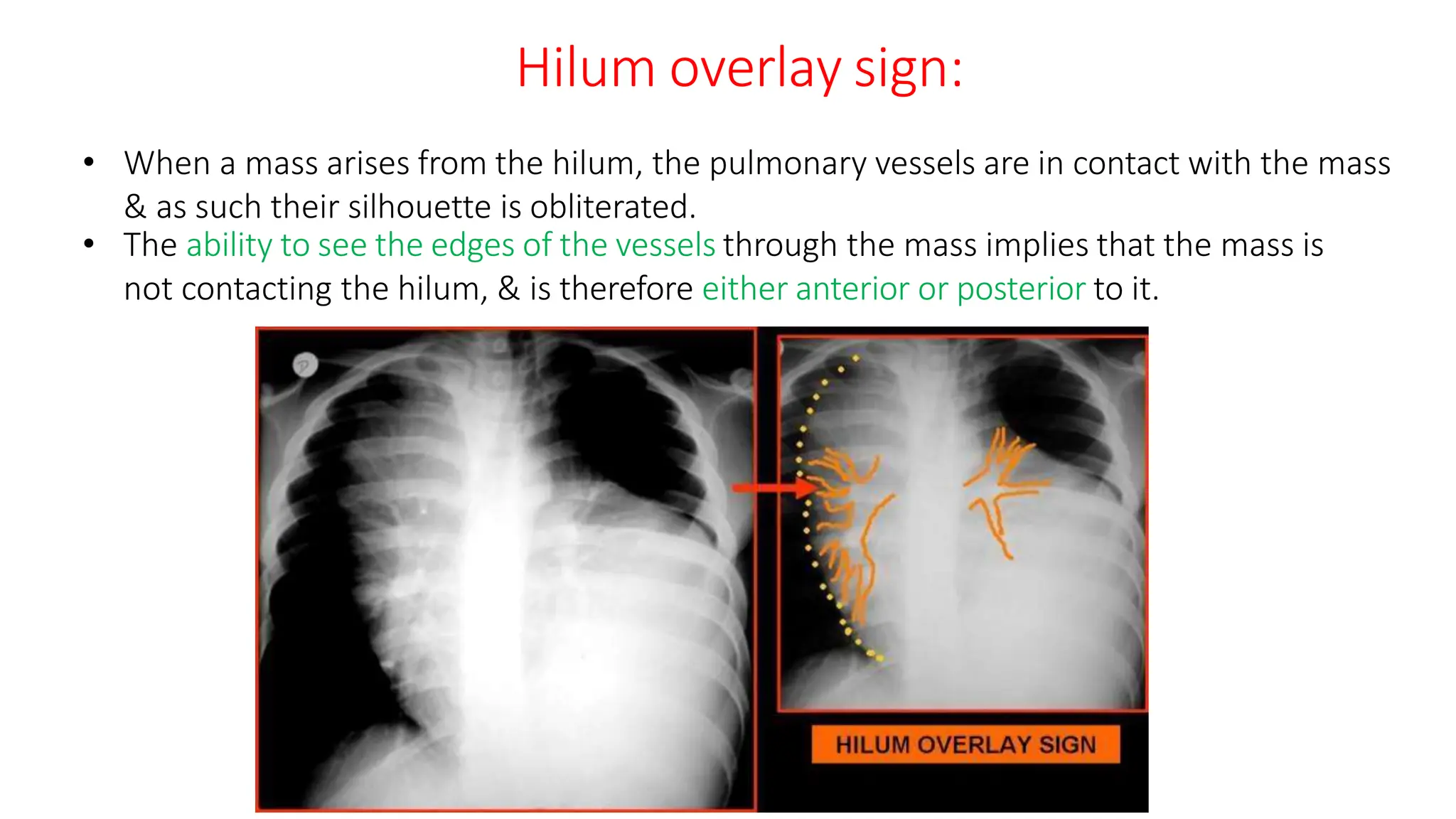 radio anatomy of meidastinum and approach to mediastinal masses.pptx