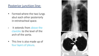 radio anatomy of meidastinum and approach to mediastinal masses.pptx