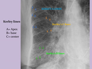 Kerley B Lines Labeled