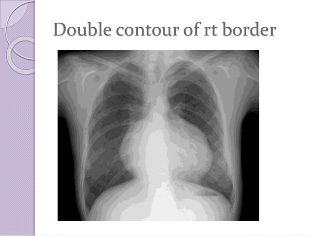chest radiology in cardiovascular disease