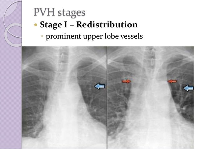 chest radiology in cardiovascular disease