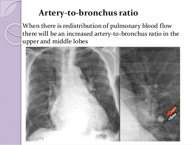 Pulmonary Artery X Ray