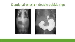 x ray approach for pediatrics and diagnosis | PPTX