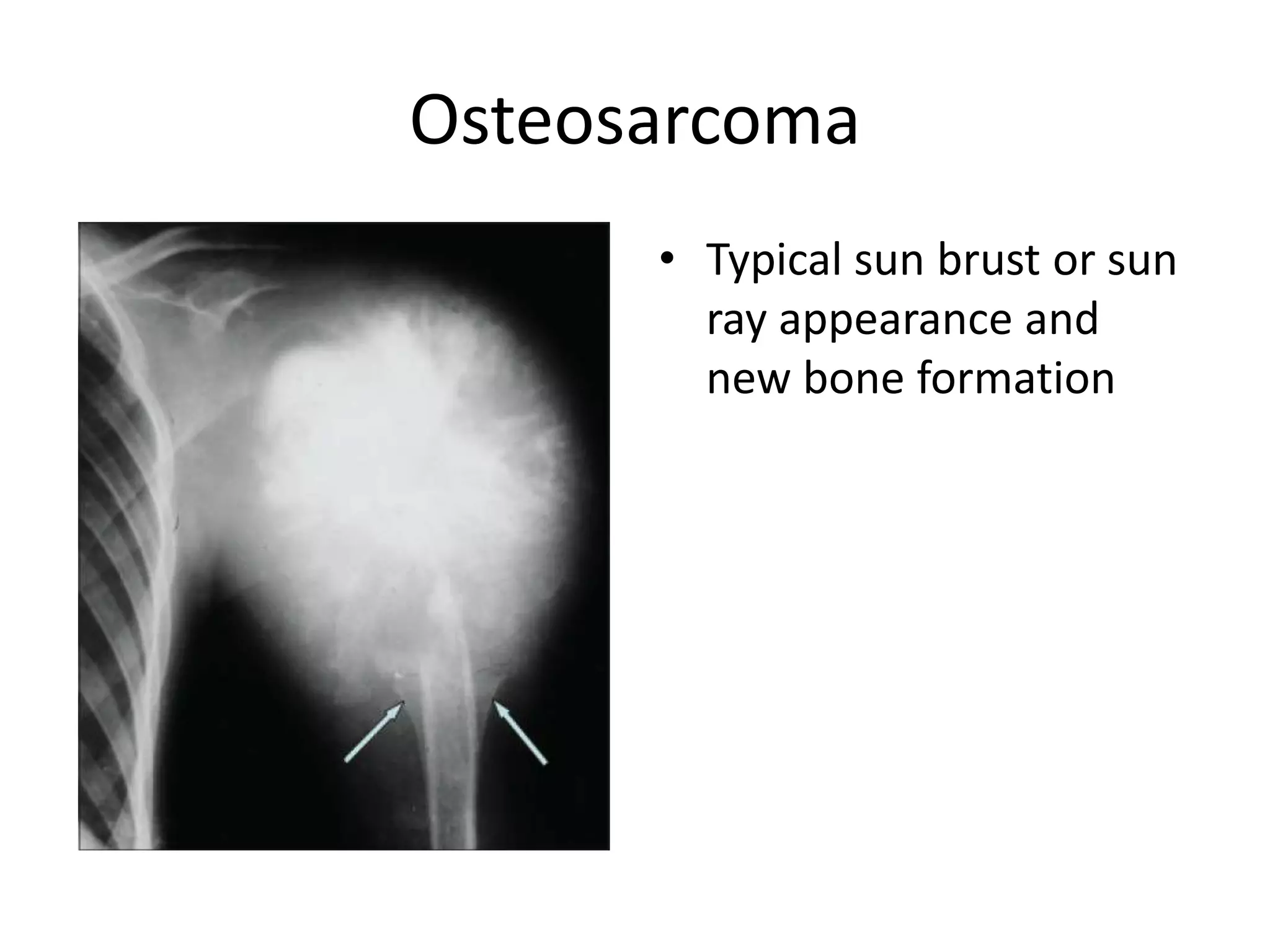 X ray finding in Bone Tumors.pptx