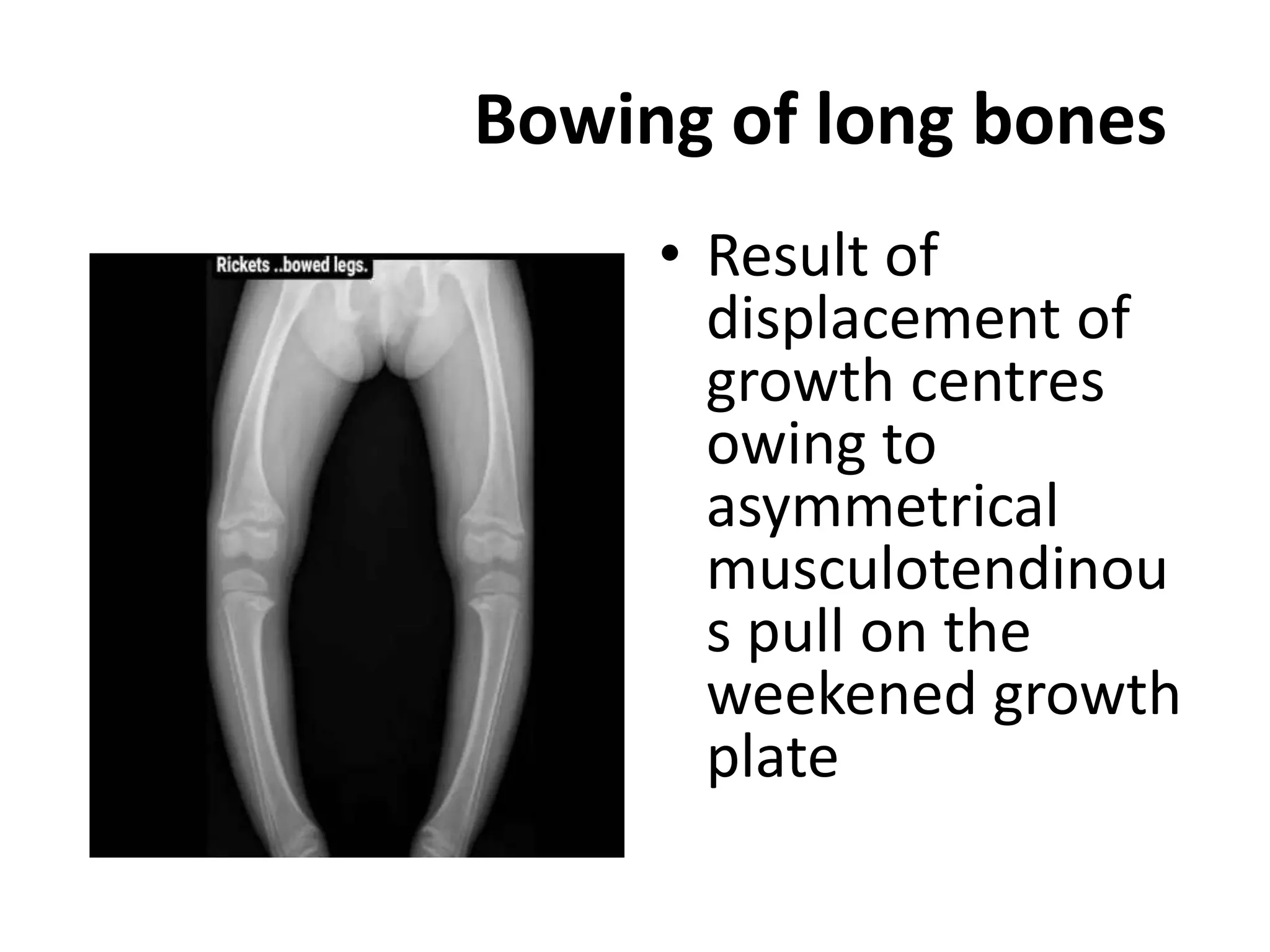 X ray finding in Bone Tumors.pptx