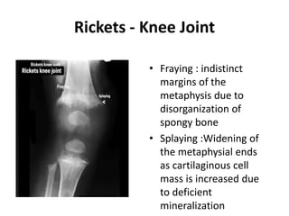 X ray finding in Bone Tumors.pptx