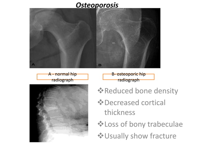 X ray finding in Bone Tumors.pptx