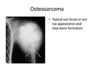 X ray finding in Bone Tumors.pptx