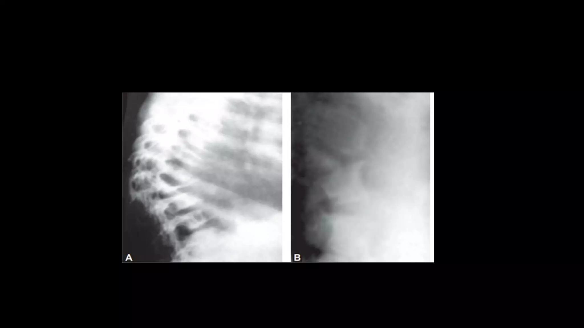 Xray findings of tb spine | PPTX