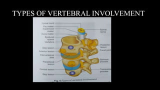 Xray findings of tb spine | PPTX