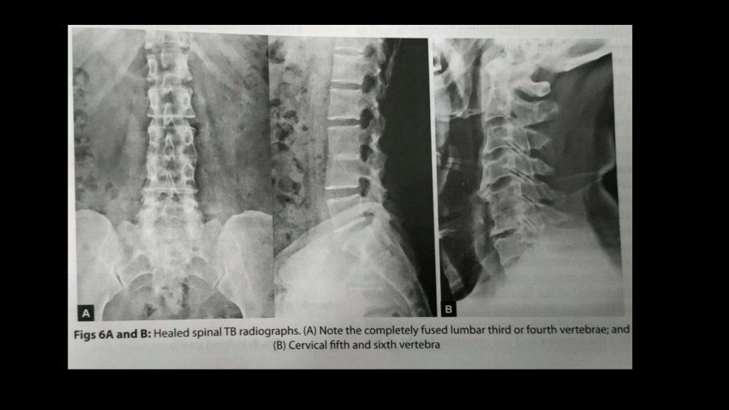 Xray findings of tb spine