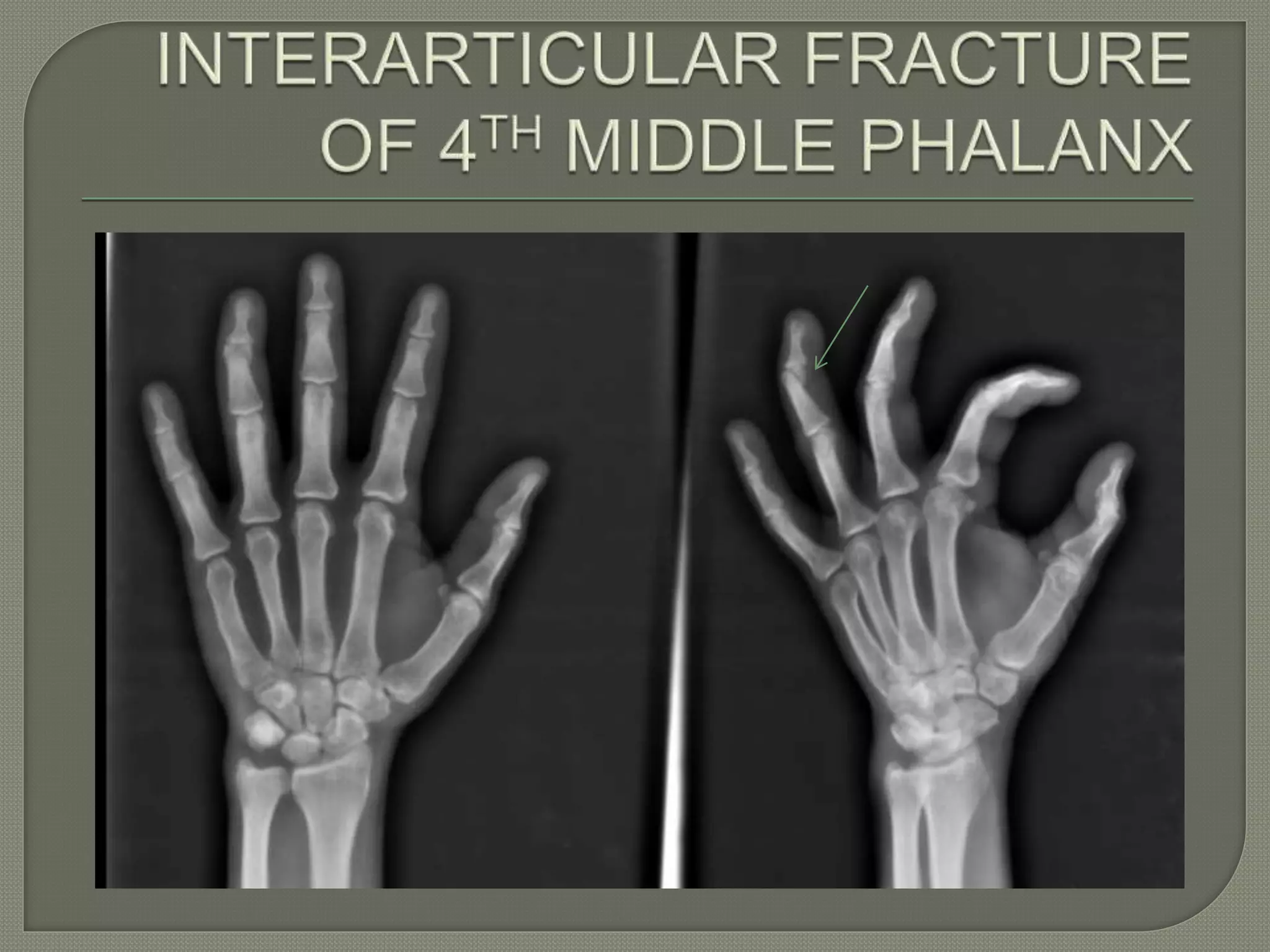 DIFFERENT TYPES OF FRACTURES IN HAND XRAY .pptx
