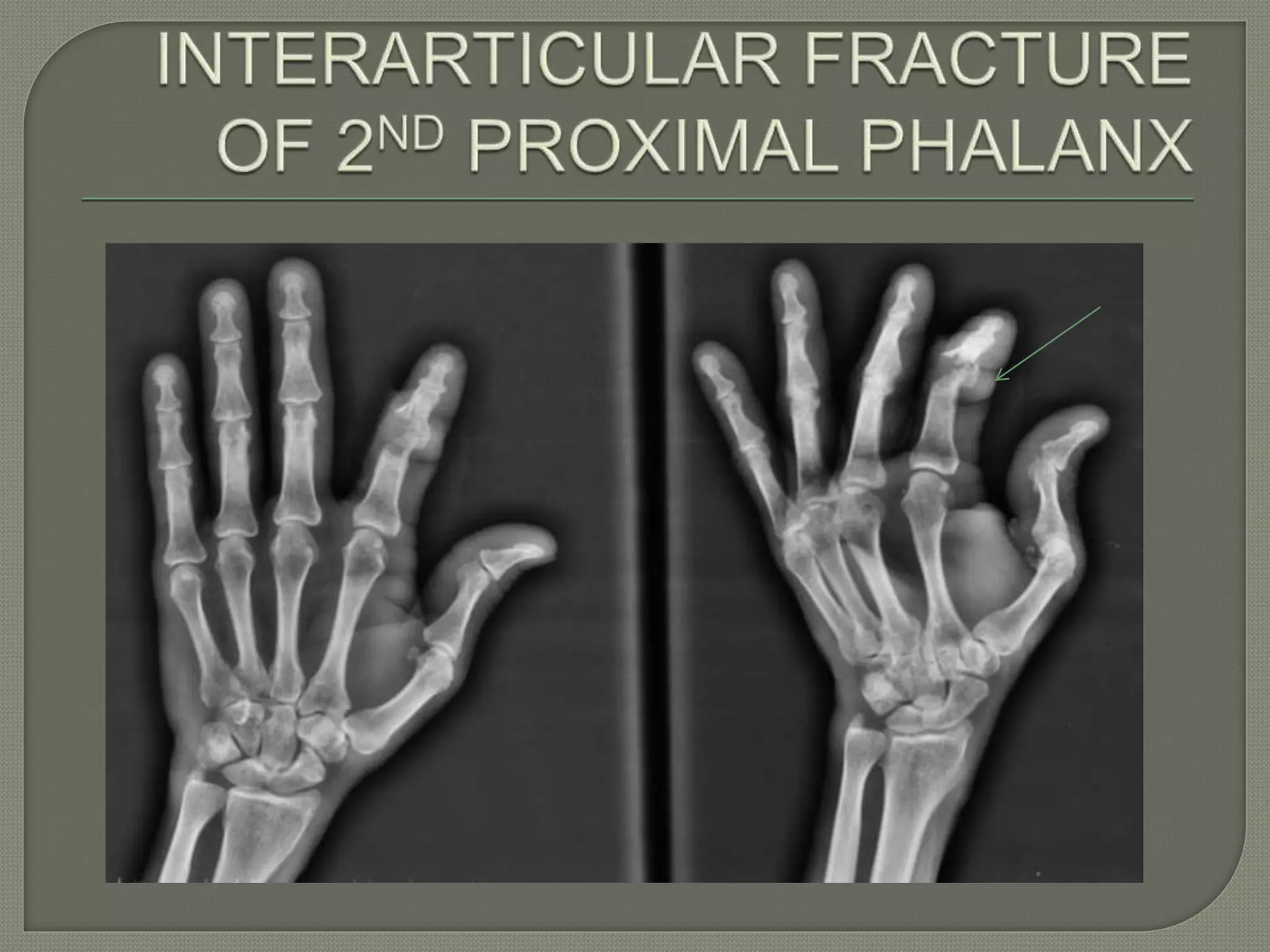 DIFFERENT TYPES OF FRACTURES IN HAND XRAY .pptx