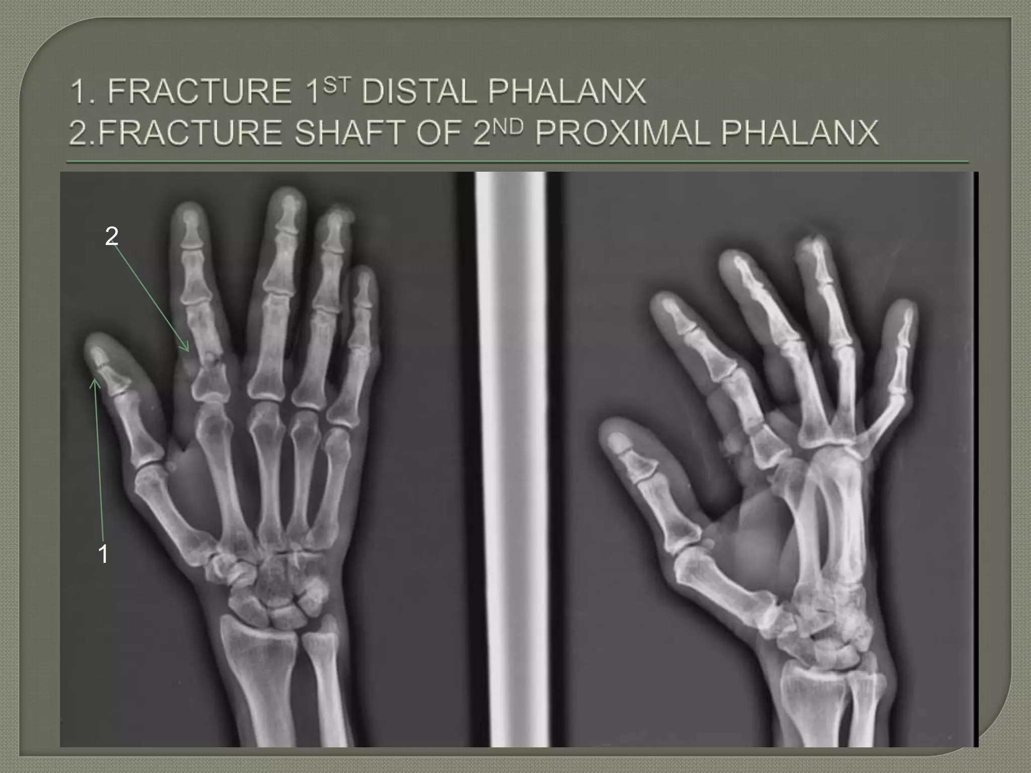 DIFFERENT TYPES OF FRACTURES IN HAND XRAY .pptx