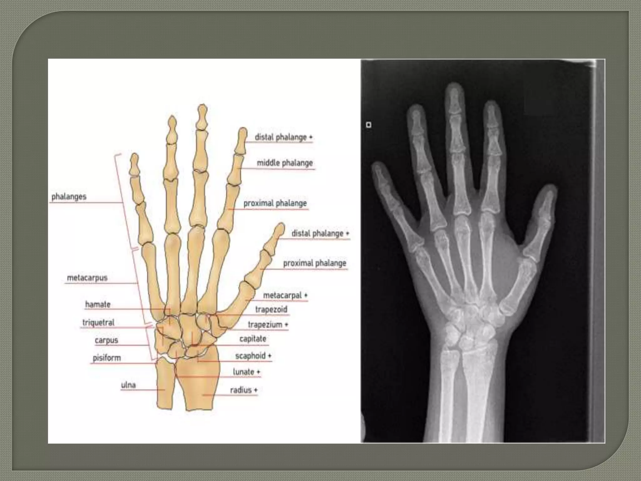 DIFFERENT TYPES OF FRACTURES IN HAND XRAY .pptx