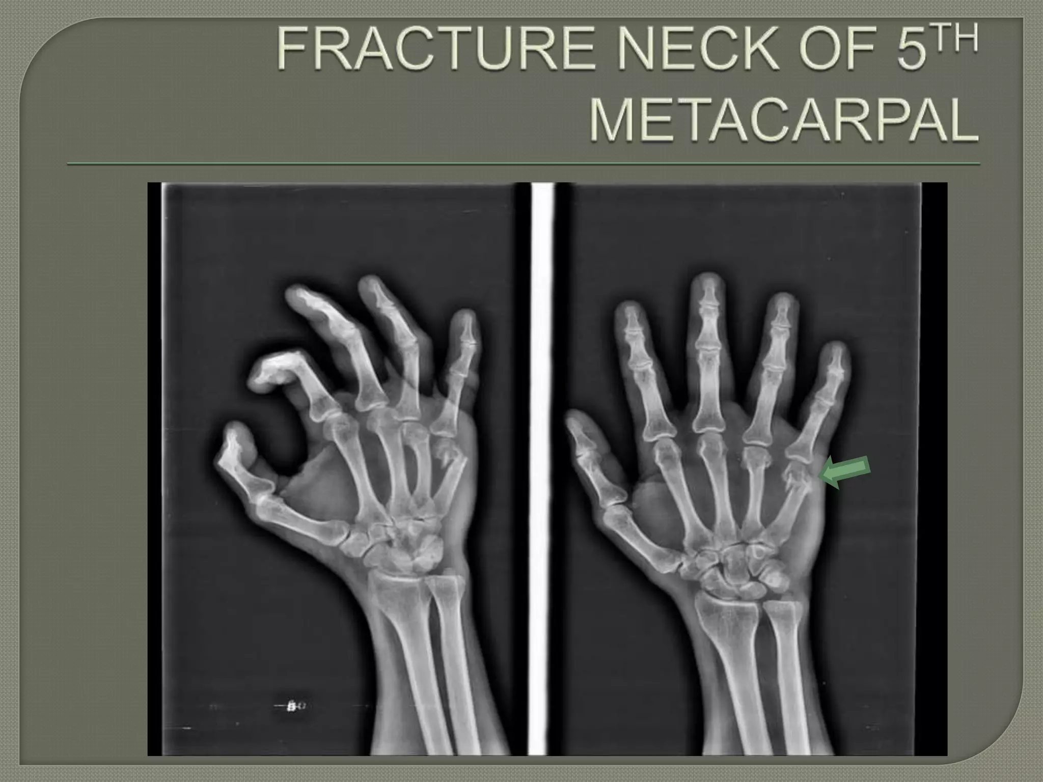 DIFFERENT TYPES OF FRACTURES IN HAND XRAY .pptx