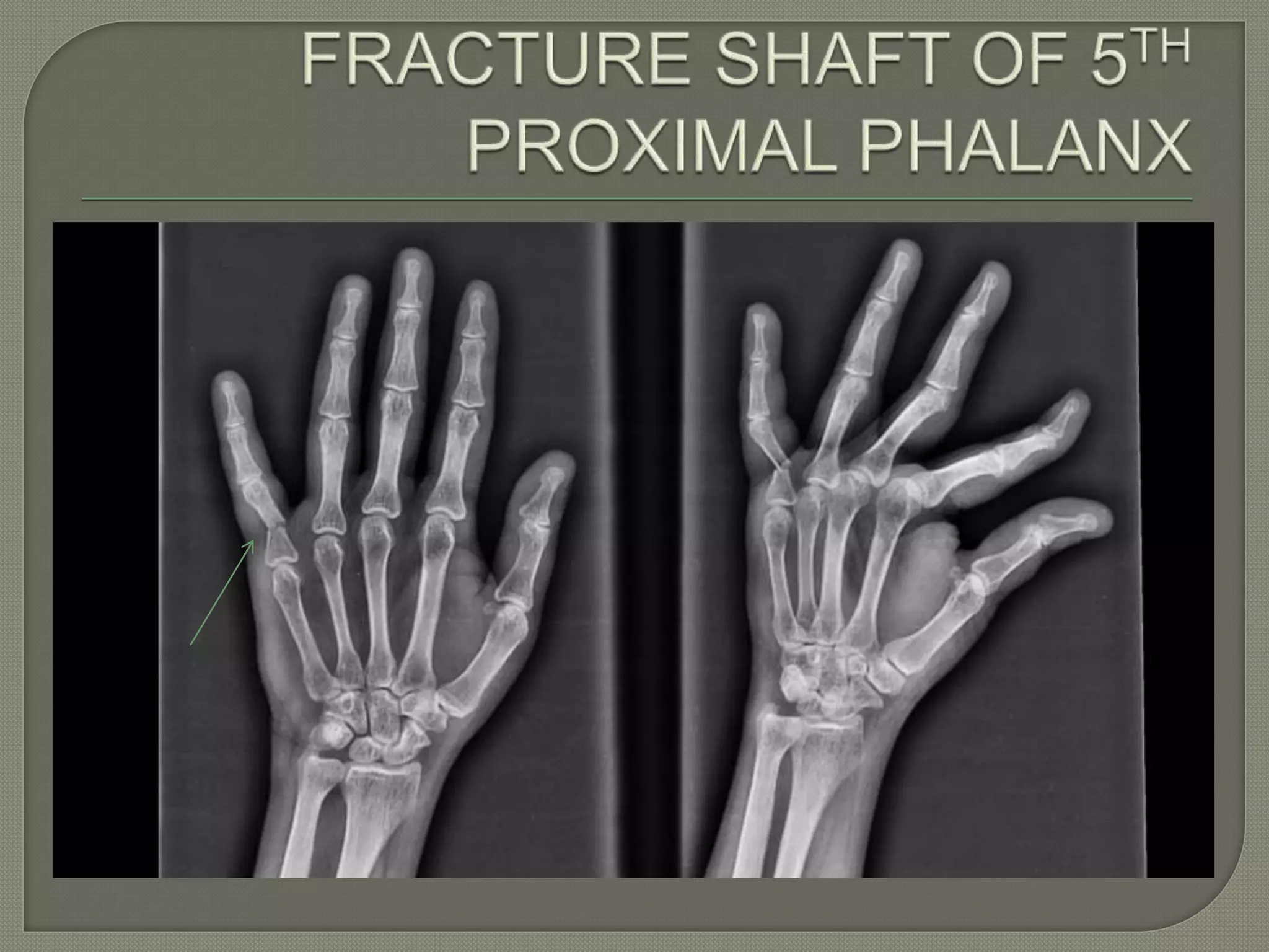 DIFFERENT TYPES OF FRACTURES IN HAND XRAY .pptx