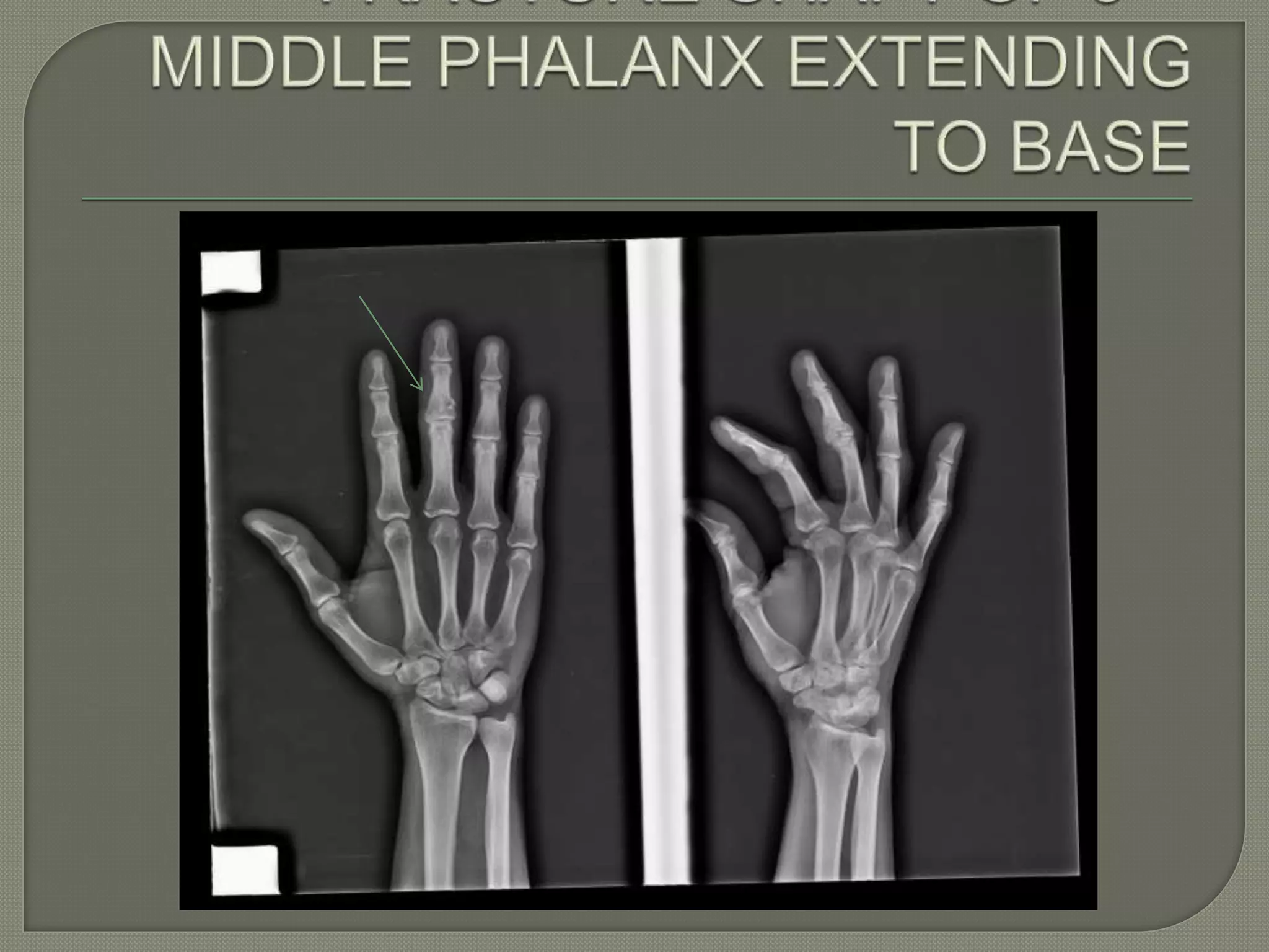 DIFFERENT TYPES OF FRACTURES IN HAND XRAY .pptx