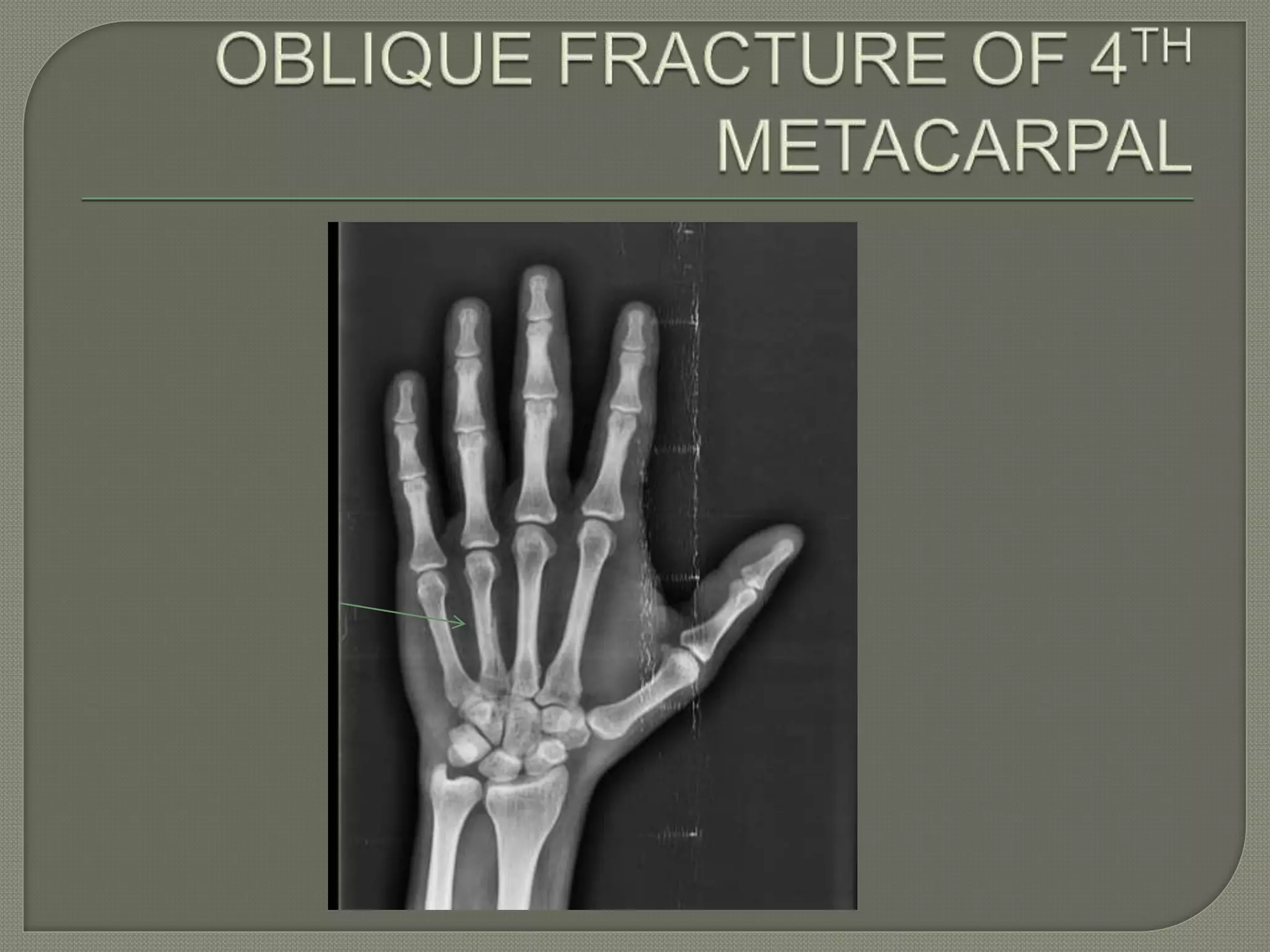 DIFFERENT TYPES OF FRACTURES IN HAND XRAY .pptx