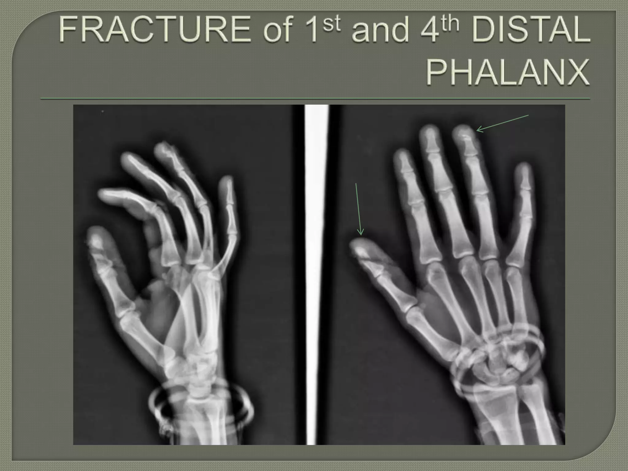 DIFFERENT TYPES OF FRACTURES IN HAND XRAY .pptx