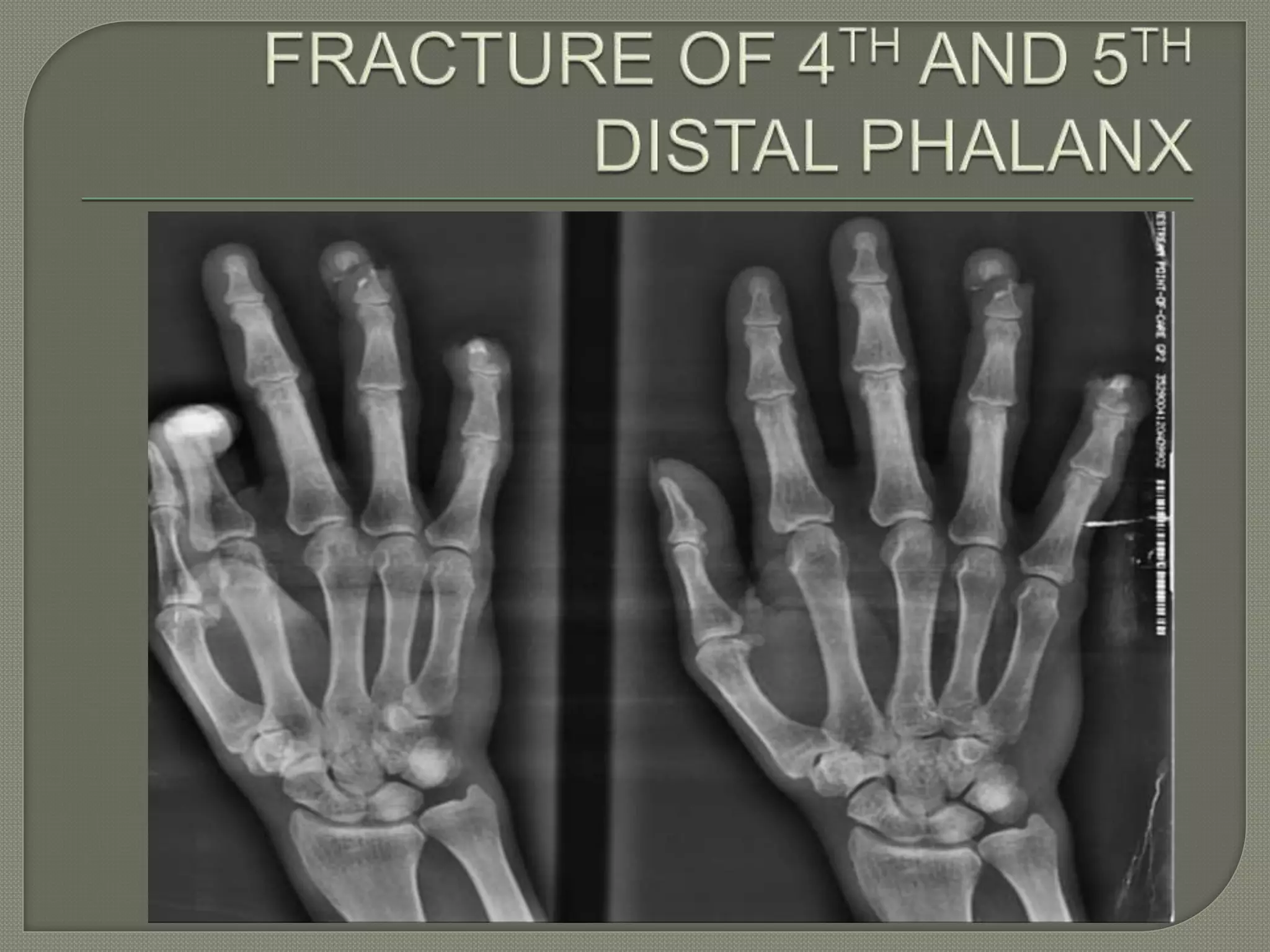 DIFFERENT TYPES OF FRACTURES IN HAND XRAY .pptx