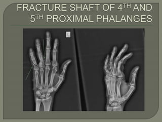 DIFFERENT TYPES OF FRACTURES IN HAND XRAY .pptx