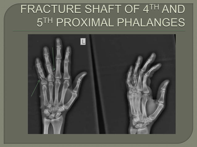 DIFFERENT TYPES OF FRACTURES IN HAND XRAY .pptx