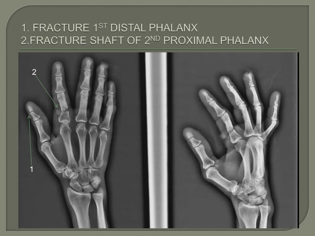 DIFFERENT TYPES OF FRACTURES IN HAND XRAY .pptx