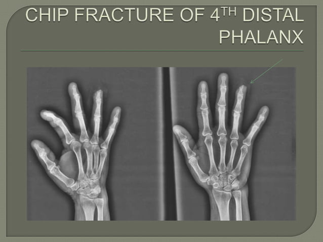 DIFFERENT TYPES OF FRACTURES IN HAND XRAY .pptx