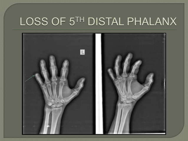DIFFERENT TYPES OF FRACTURES IN HAND XRAY .pptx