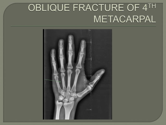 DIFFERENT TYPES OF FRACTURES IN HAND XRAY .pptx