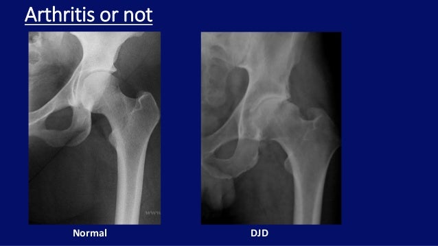 Xray imaging in non inflammatory arthritis