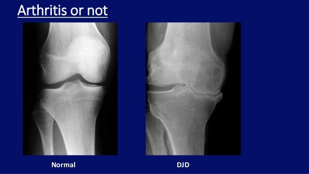 Xray imaging in non inflammatory arthritis