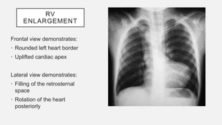 Xray in Congenital Heart Disease - .pptx