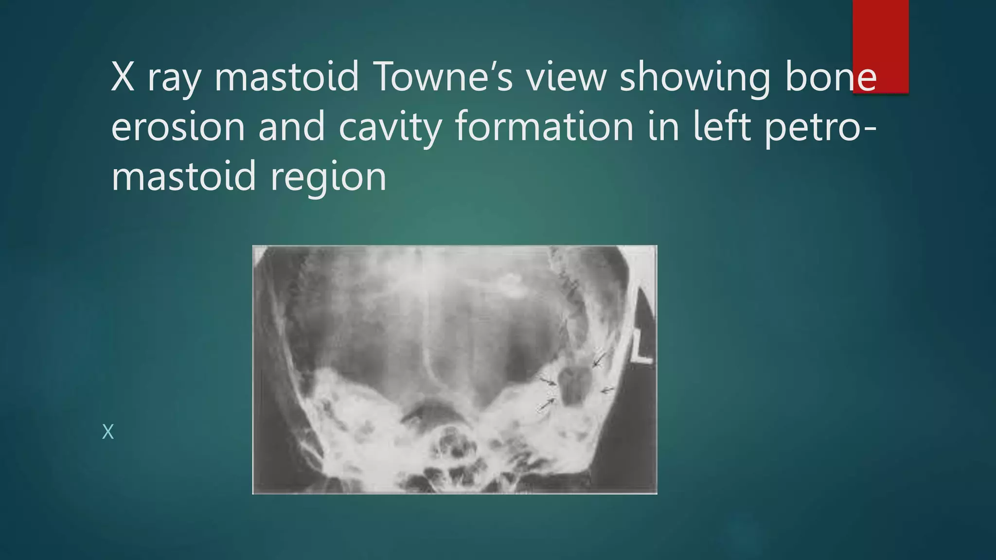 X ray in ENT.pptx