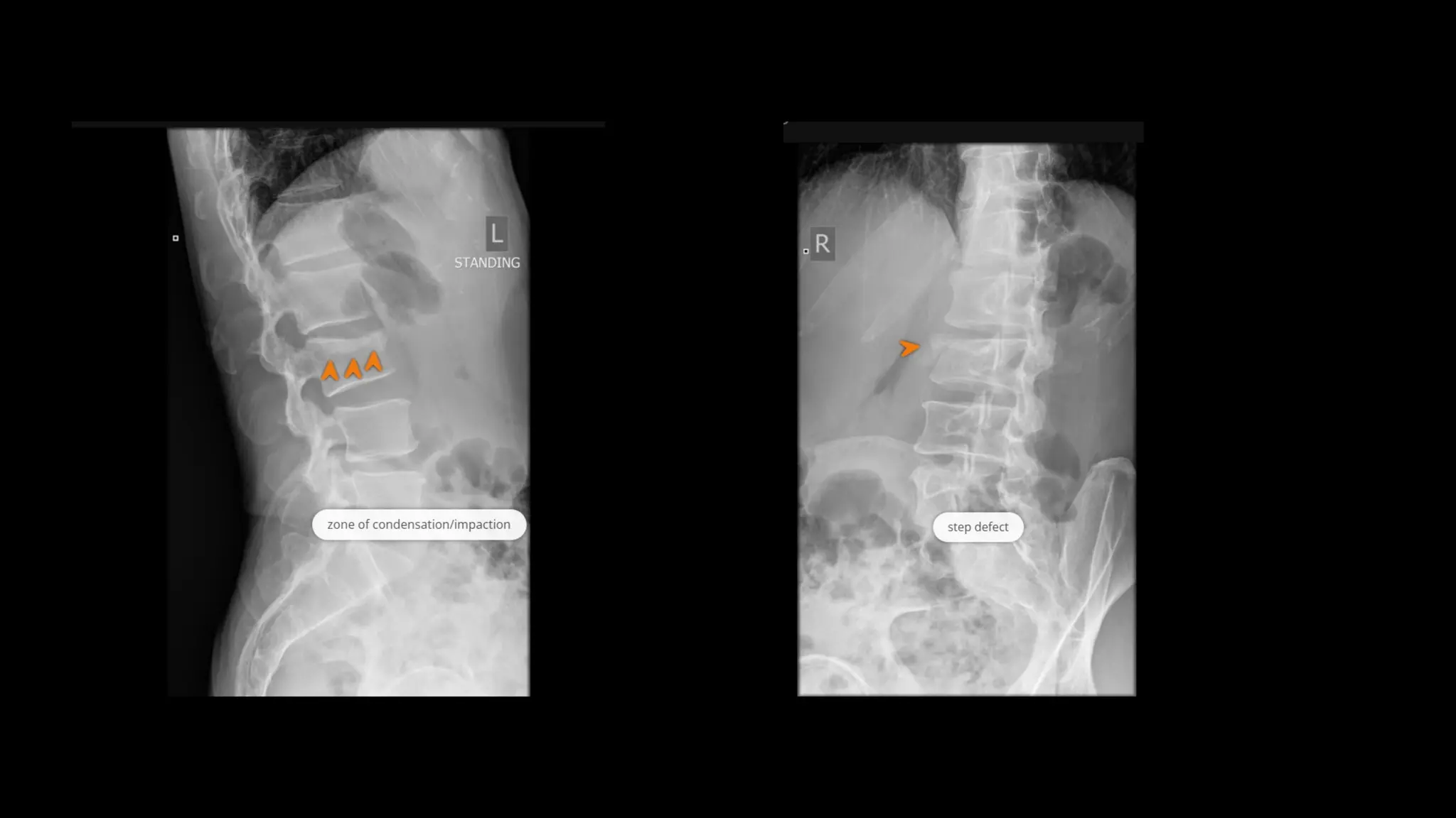 X ray Lumbosacral spine/ l s spine..... | PPTX