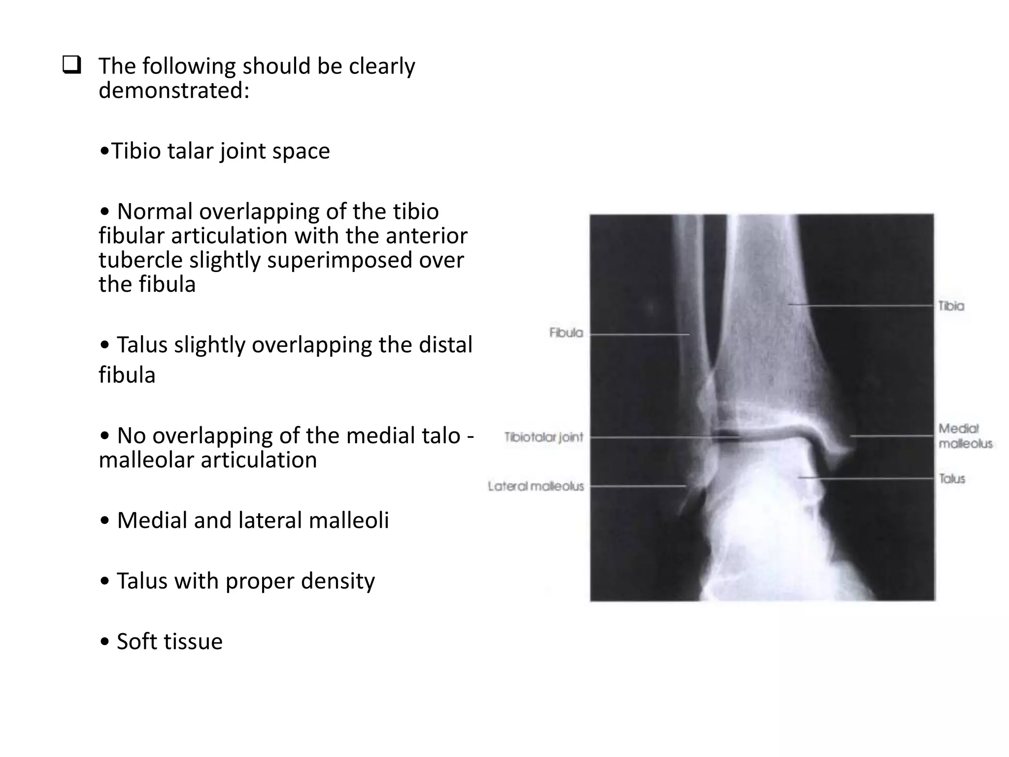 X ray of foot and ankle | PPTX