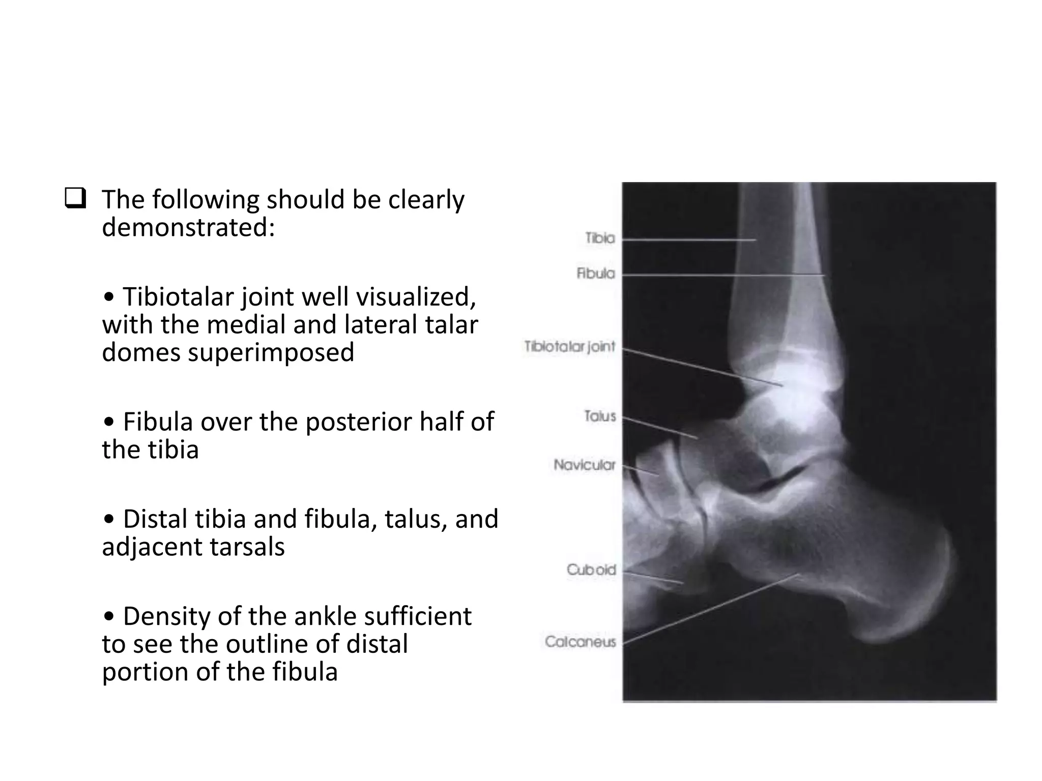X ray of foot and ankle | PPTX