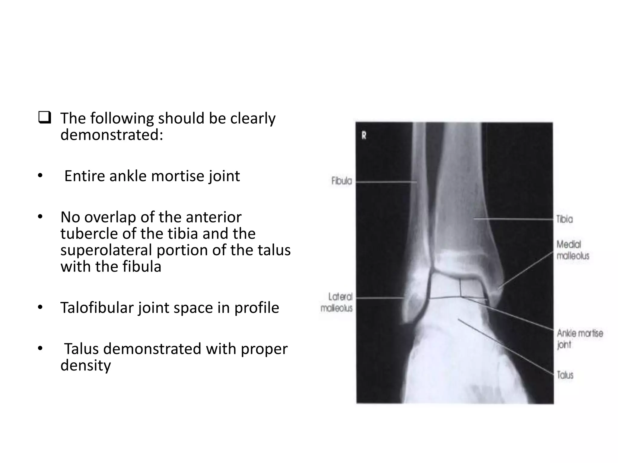 X ray of foot and ankle | PPTX