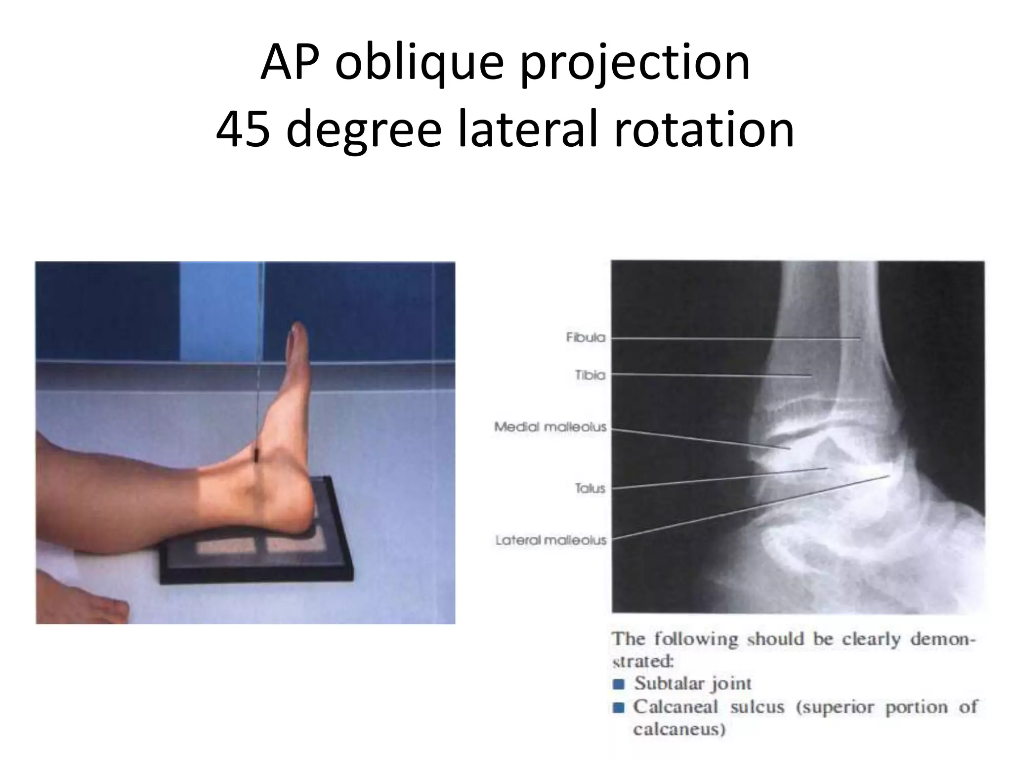 X ray of foot and ankle | PPTX