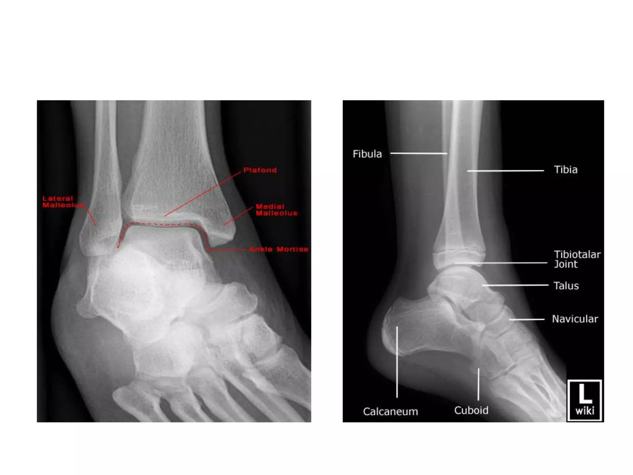 X ray of foot and ankle | PPTX